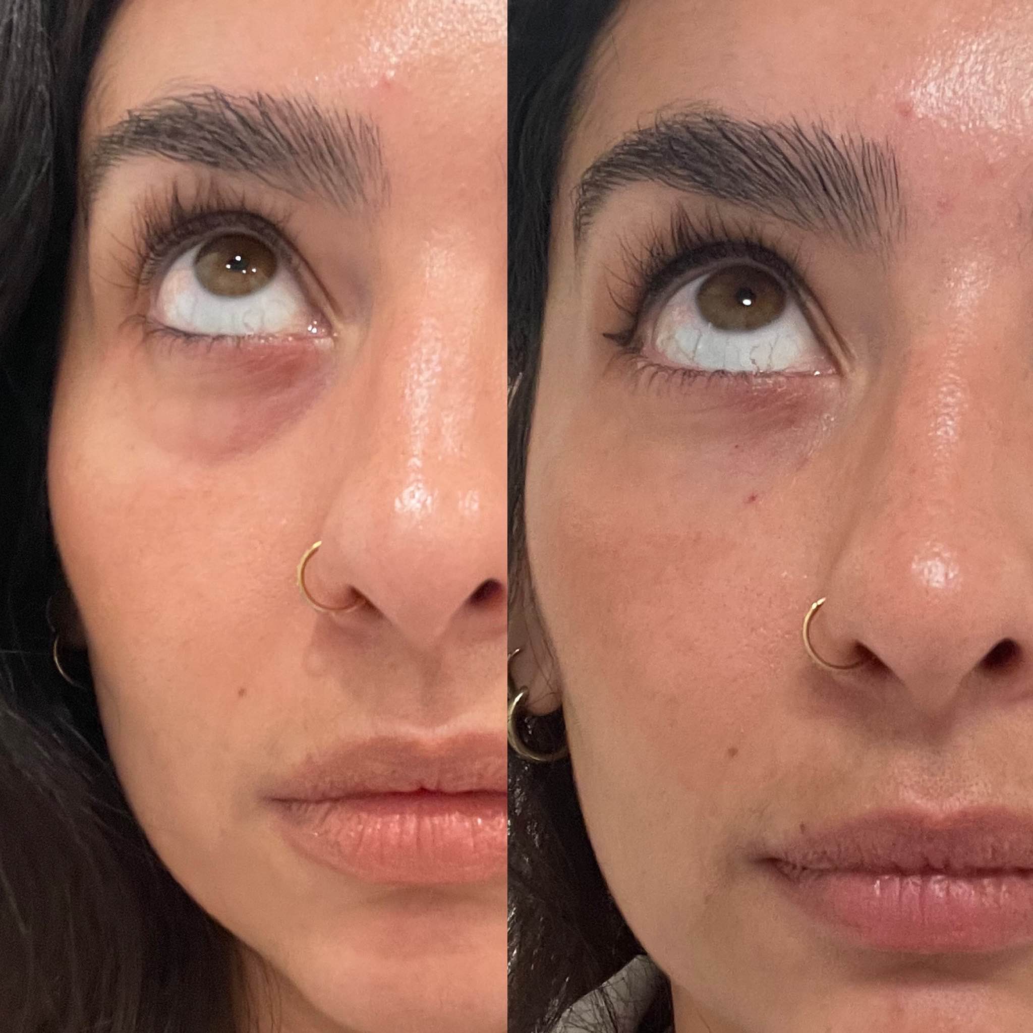 PRP/PRF For Under-Eyes | Medspa of St. Louis